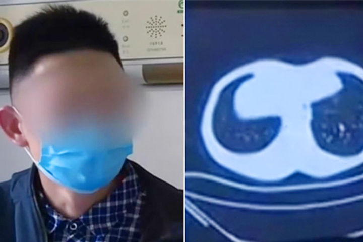 Chinese man raw snake's gall bladder, now his lungs are filled with ...